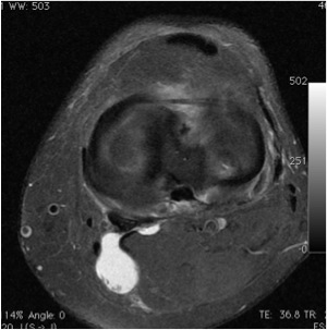 Arthrose du genou à Paris : Galerie Photos - Clinique Domont