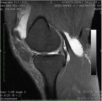 Arthrose du genou à Paris : Galerie Photos - Clinique Domont
